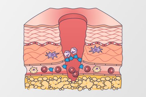 Wound Healing Process - Derma Vivere